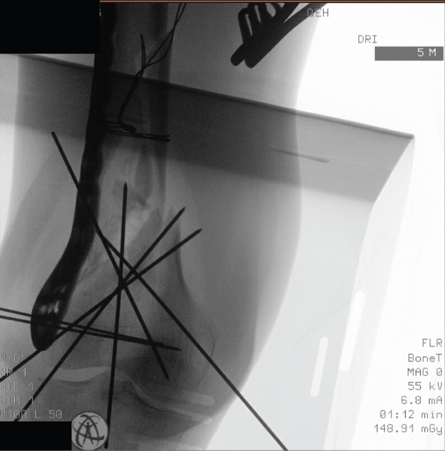 Journal of Orthopedic Surgery and Techniques | Best Scientific Journals