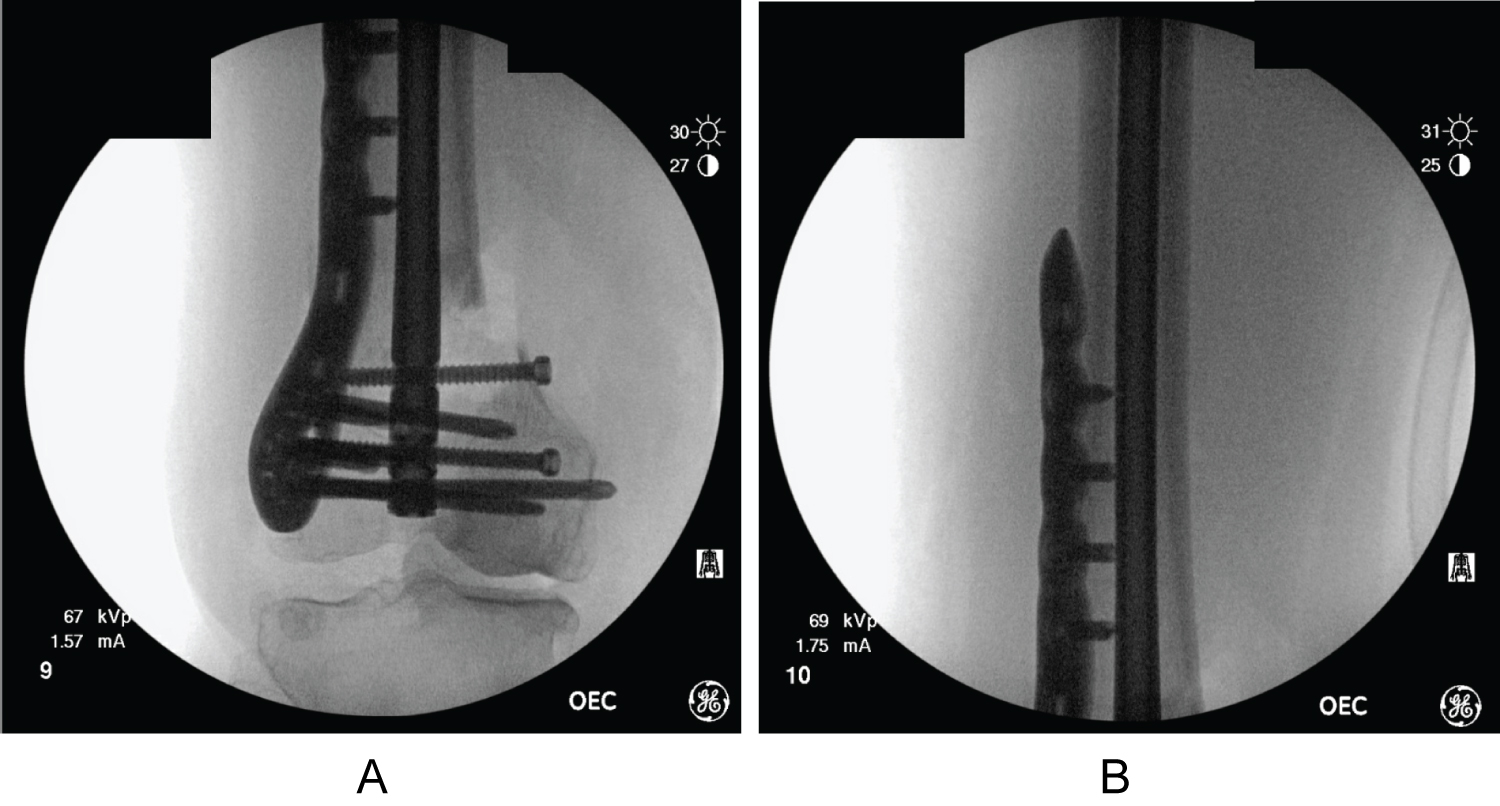 Journal of Orthopedic Surgery and Techniques | Best Scientific Journals